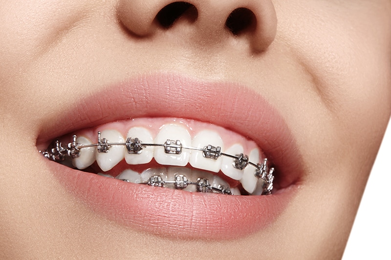 Pitts 21 vs. Traditional Braces | Murphy Orthodontics